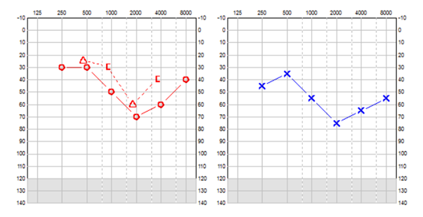 What is Audiometry? | Connect Hearing