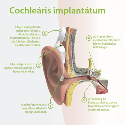 Amit a cochleáris implantátumról tudni kell | Geers