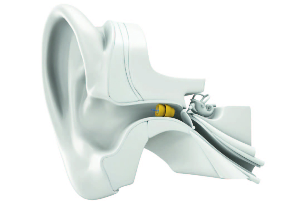 Lyric Onzichtbare hoortoestellen| Lapperre